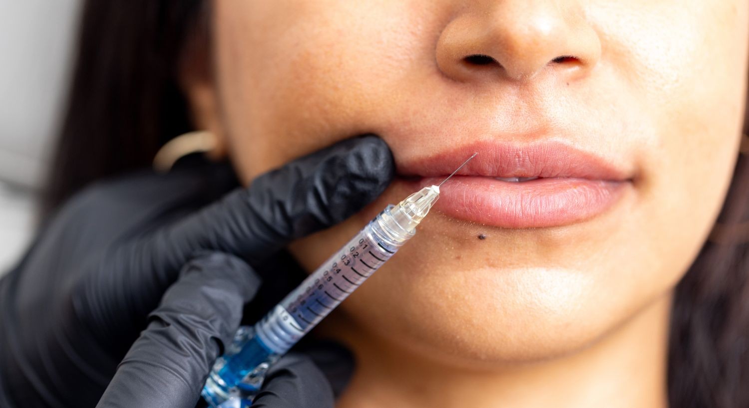 Juvederm | Dermal Fillers for Face & Lips | AlluraMD Med Spa